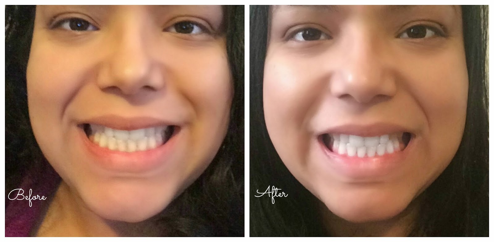 Get White Teeth Easily with Dr. Song Professional Whitening Kit - First ...