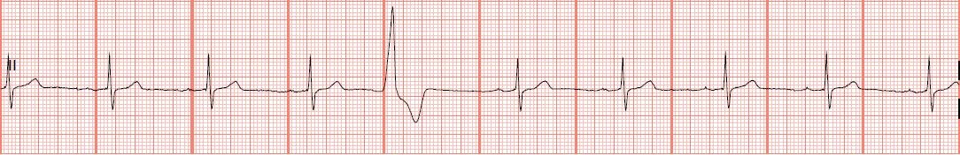 EKG Rhythm Strip Quiz 102