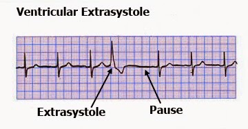Premature Ventricular Contraction / Ventrikular Ekstrasistol | INA - ECG