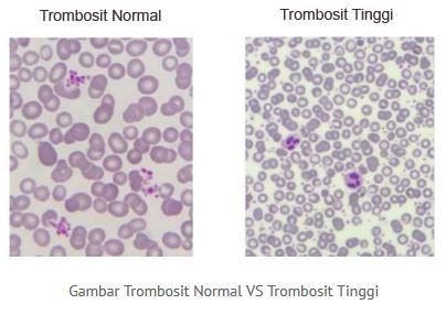 Inilah Penyebab Trombosit Tinggi dan Penyebabnya
