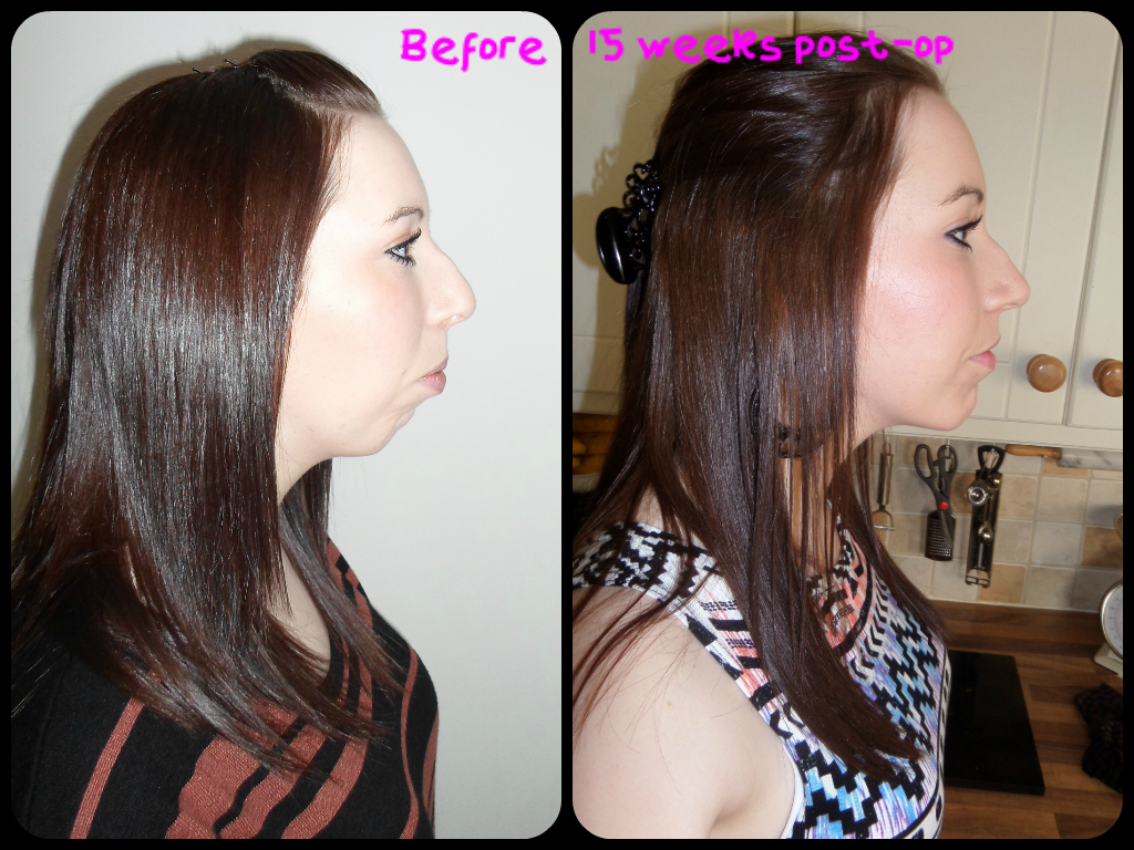 My jaw surgery and I..: Day 105: Photo Updates