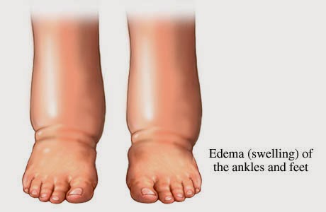treatment for kidney disease: Edema in Chronic Kidney Disease (CKD)