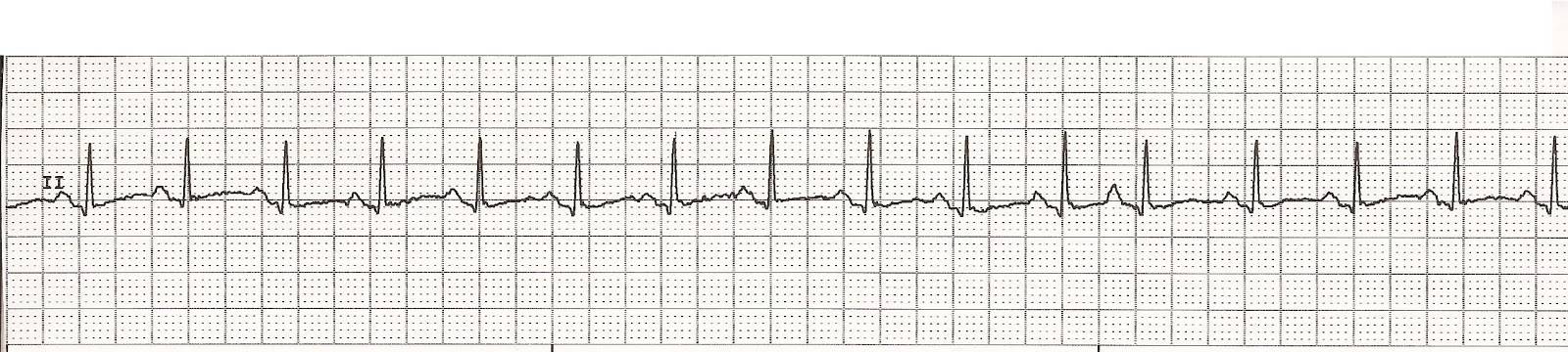 ECG Rhythm Strips 74