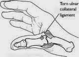 Medical Treatment Pictures-for Better Understanding: Arthroscopic Thumb ...
