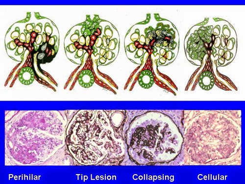 USMLE COMLEX Study Guides : Renal Pathology: Glomerular Diseases