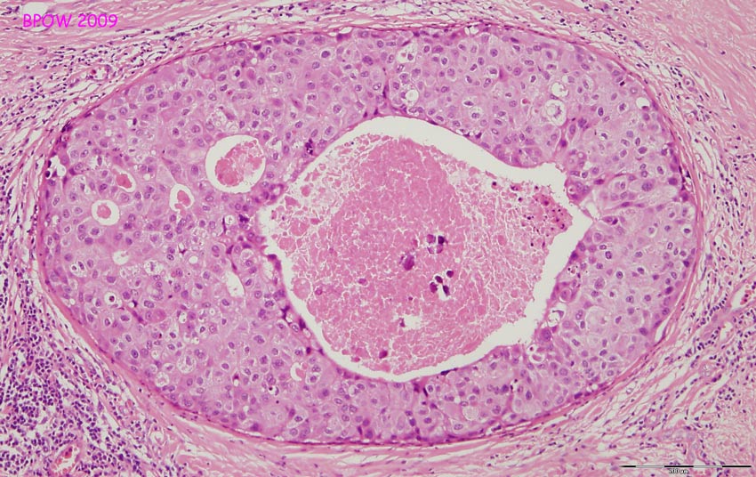 Pathology Cases: N2a