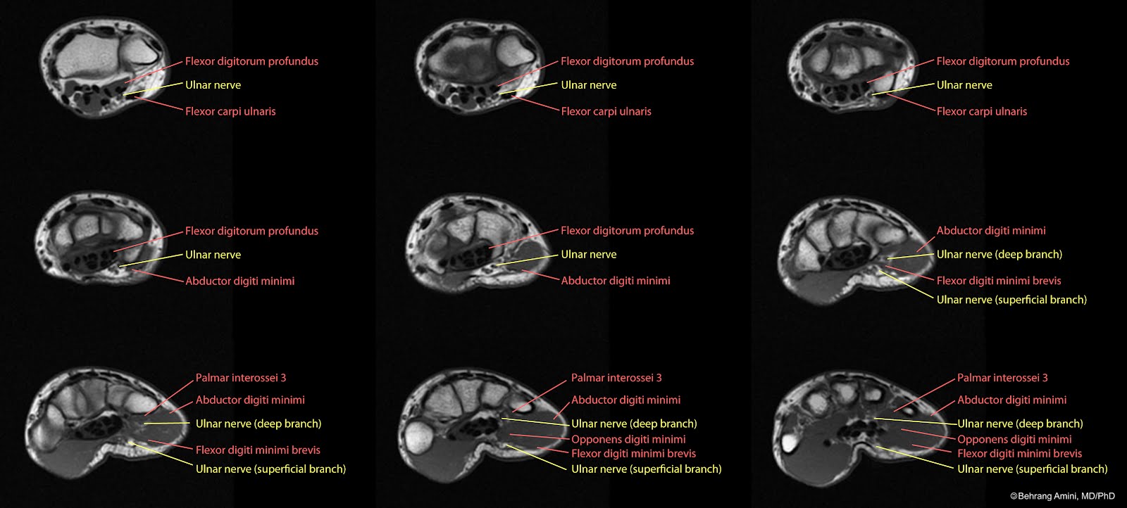 Roentgen Ray Reader: Anatomy of the Volar Branch of the Ulnar Nerve at ...