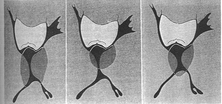 PROTESIS FIJA METAL: PROTESIS FIJA