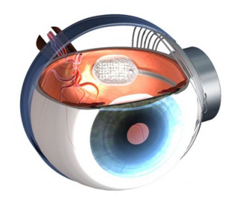 Avances en medicina T.5: El ojo biónico. Marta (2)