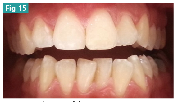 Molar Incisor Hypomineralization (MIH): Conservative Treatment Approach