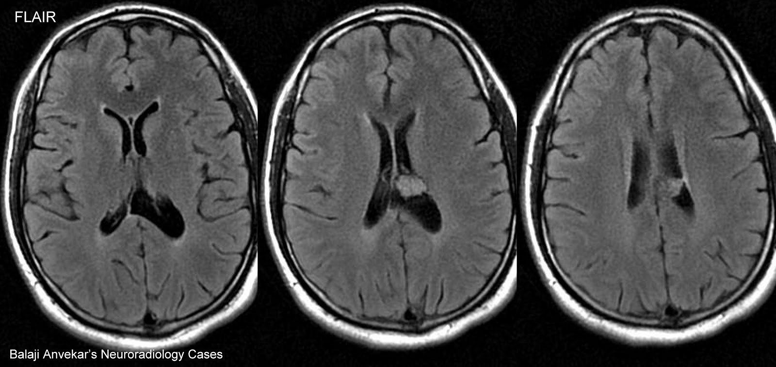Dr Balaji Anvekar FRCR: Intraventricular Cavernoma