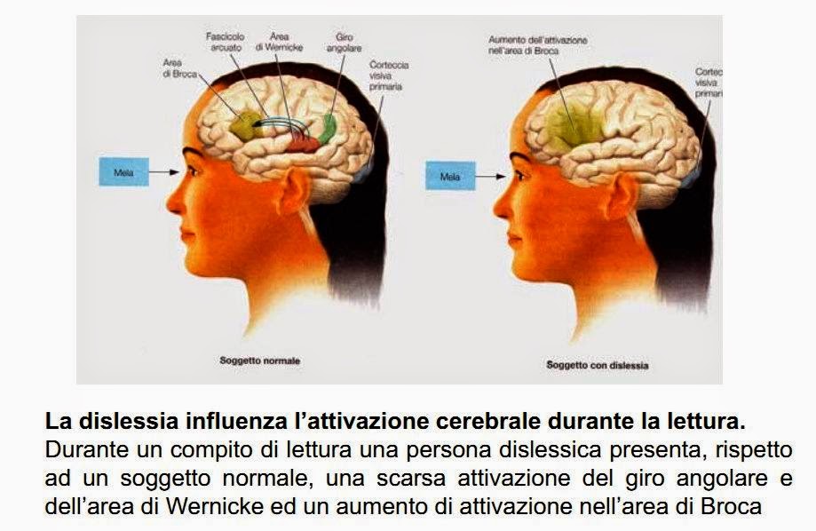 Didattica e Cervello: Lateralizzazione cerebrale, mancinismo e dislessia