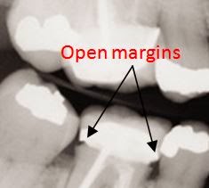 Pain from dental crown