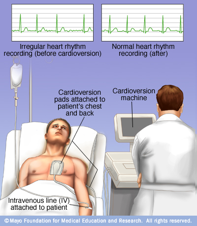 The Kalef's: Atrial Flutter Options