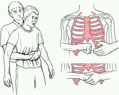 World Health: Step First Aid for Choking