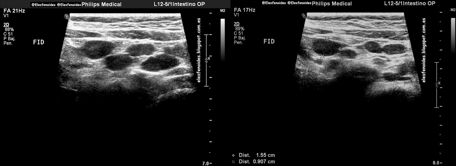 Ecografía De íleon Terminal