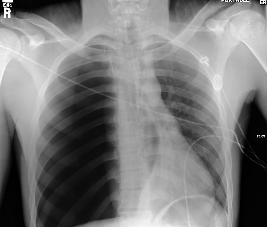 Pedi cardiology: CXR: Dextroposition & Dextrocardia/Situs inversus