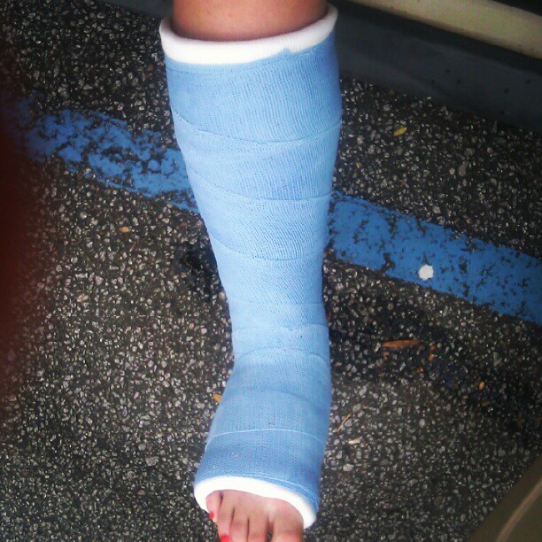 Casts and Toes: Random Cast Pics