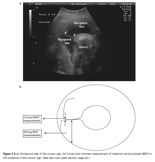 Sonographic pitfalls: the cocoon sign | Twin-Twin Transfusion Syndrome ...