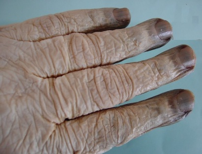 Gangrena - Doença Fatal Causada Por Infecção Ou Isquemia - Saúde ...