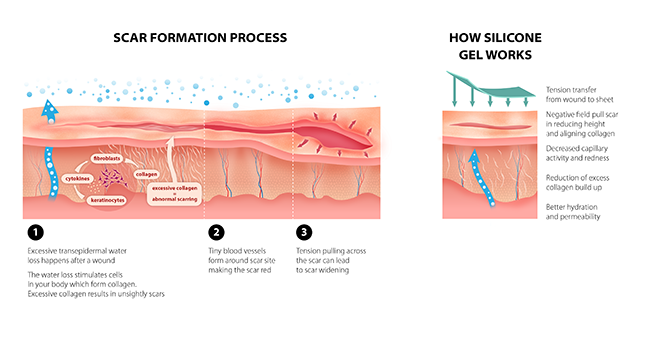 Scar Formation Process