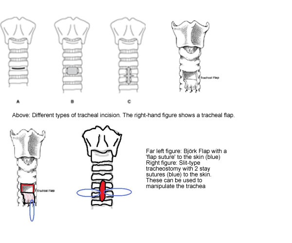 Tracheostomy Care Procedure: Tracheostomy Care Procedure