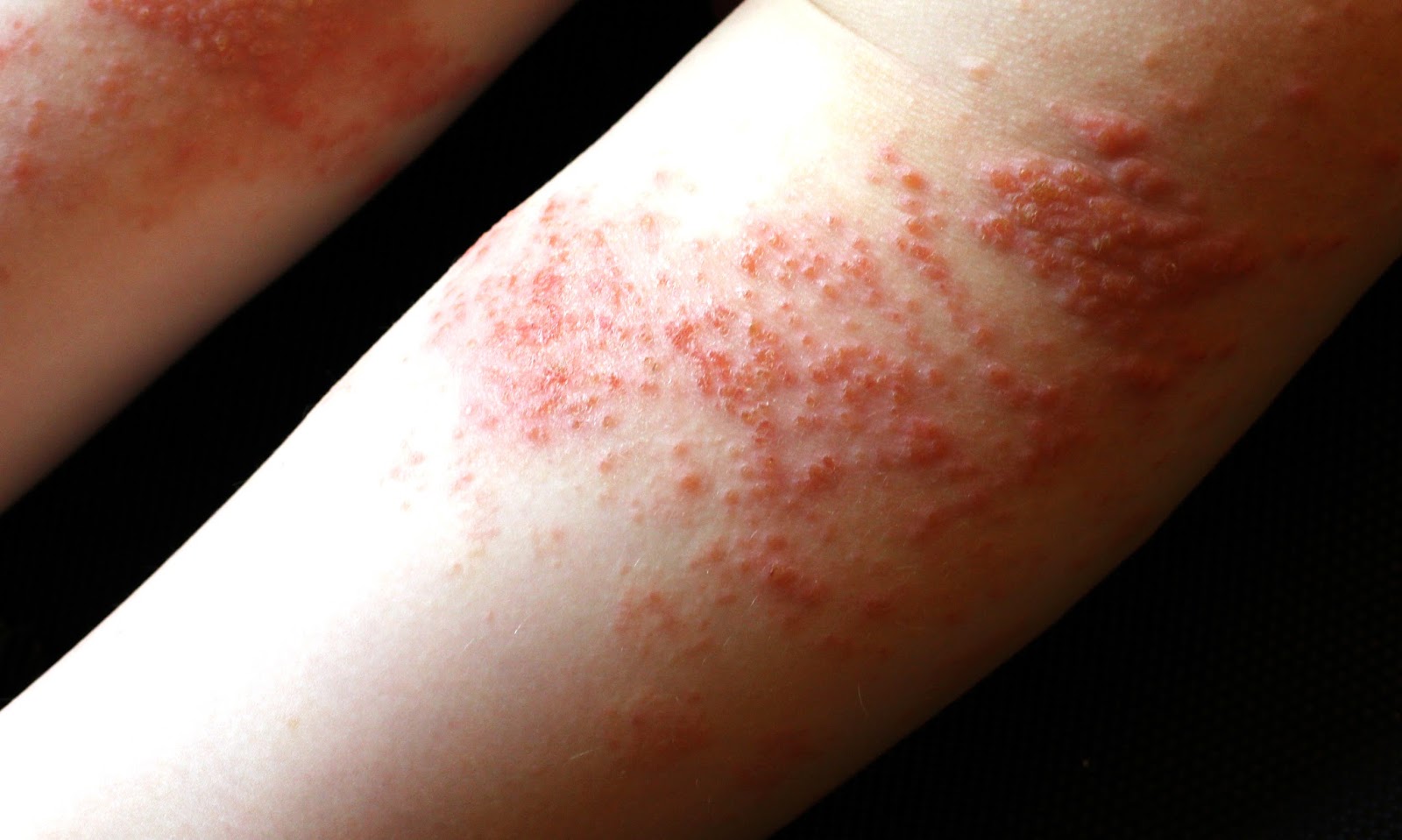 Boys, Buildings, Books and Berries: Big Bad Rash