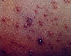 acne autour de labouche: Coxsackie Virus – Symptoms, Causes and Treatment
