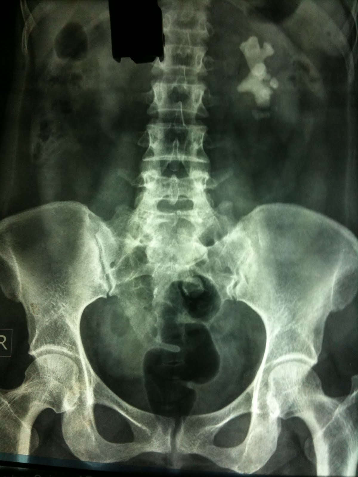 Ramayya Pramila Urology Hospital: PCNL in a complete staghorn calculus