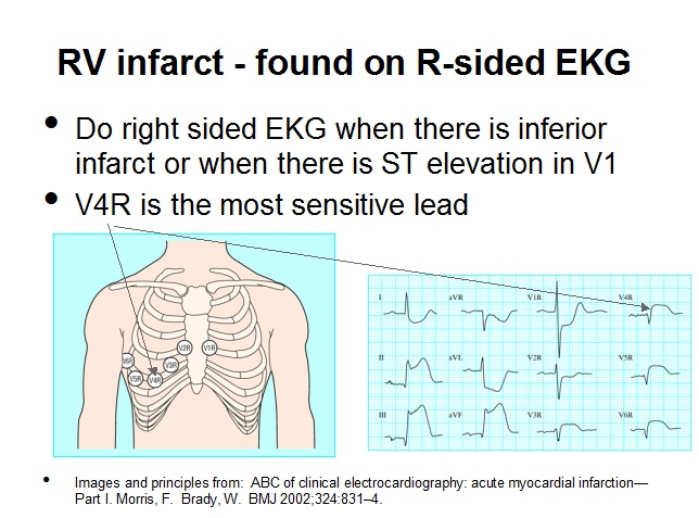 THE A.D.D. E.D.: posterior and RV myocardial infarction