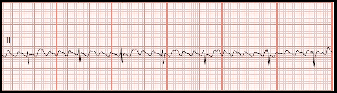 Practice EKG Rhythm Strips 117
