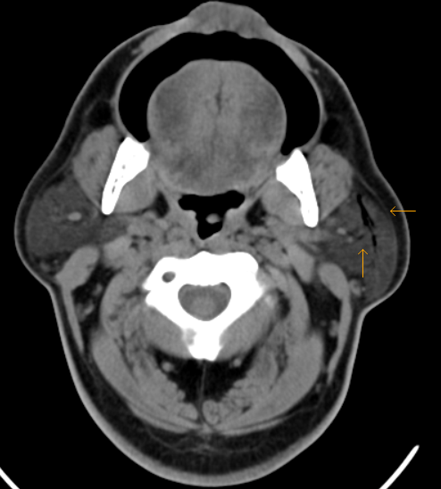 Pneumoparotid-CT - Sumer's Radiology Blog