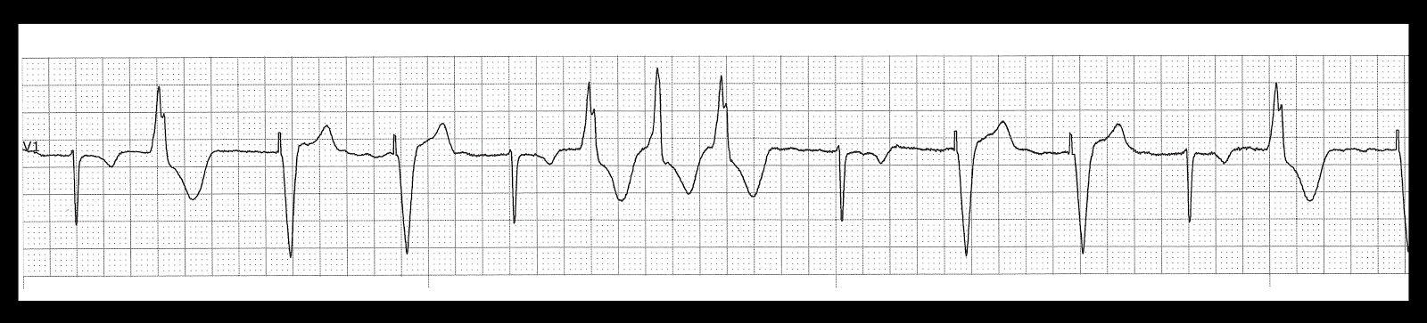 Practice EKG Strips 374