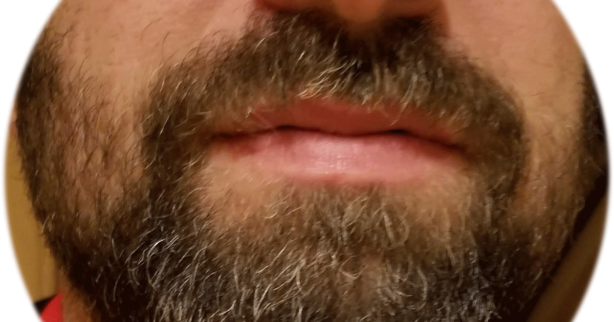 String of Medical Pearls: Is this a reason to grow a beard?