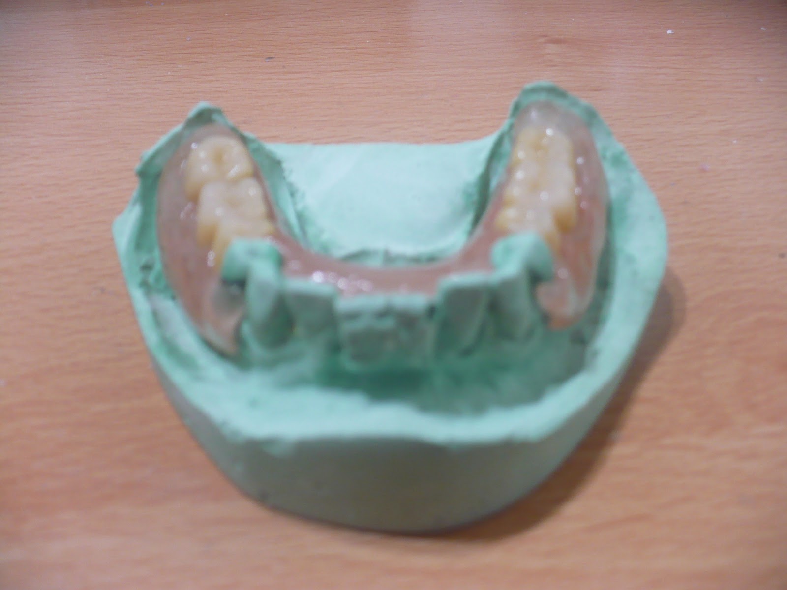 Laboratorio Dental Fernando Emmanueli: Protesis Parcial Deflex