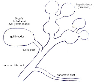 ABC Radiology Blog: Todani Classification Of Bile Duct Cysts