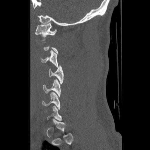 Post Gad: Bilateral Facet joint Dislocation