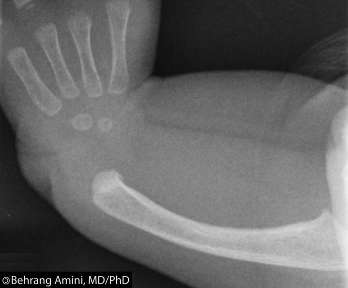 Roentgen Ray Reader: Radial Club Hand