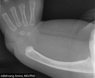 Roentgen Ray Reader: Radial Club Hand