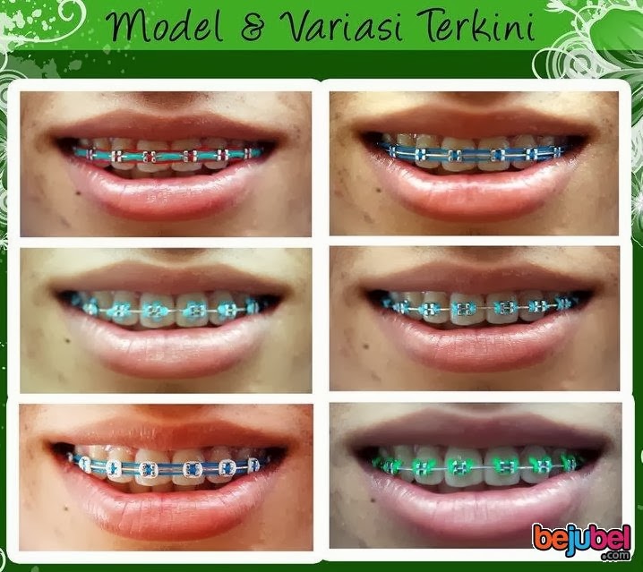 19+ Warna Karet Behel Bening, Paling Top!