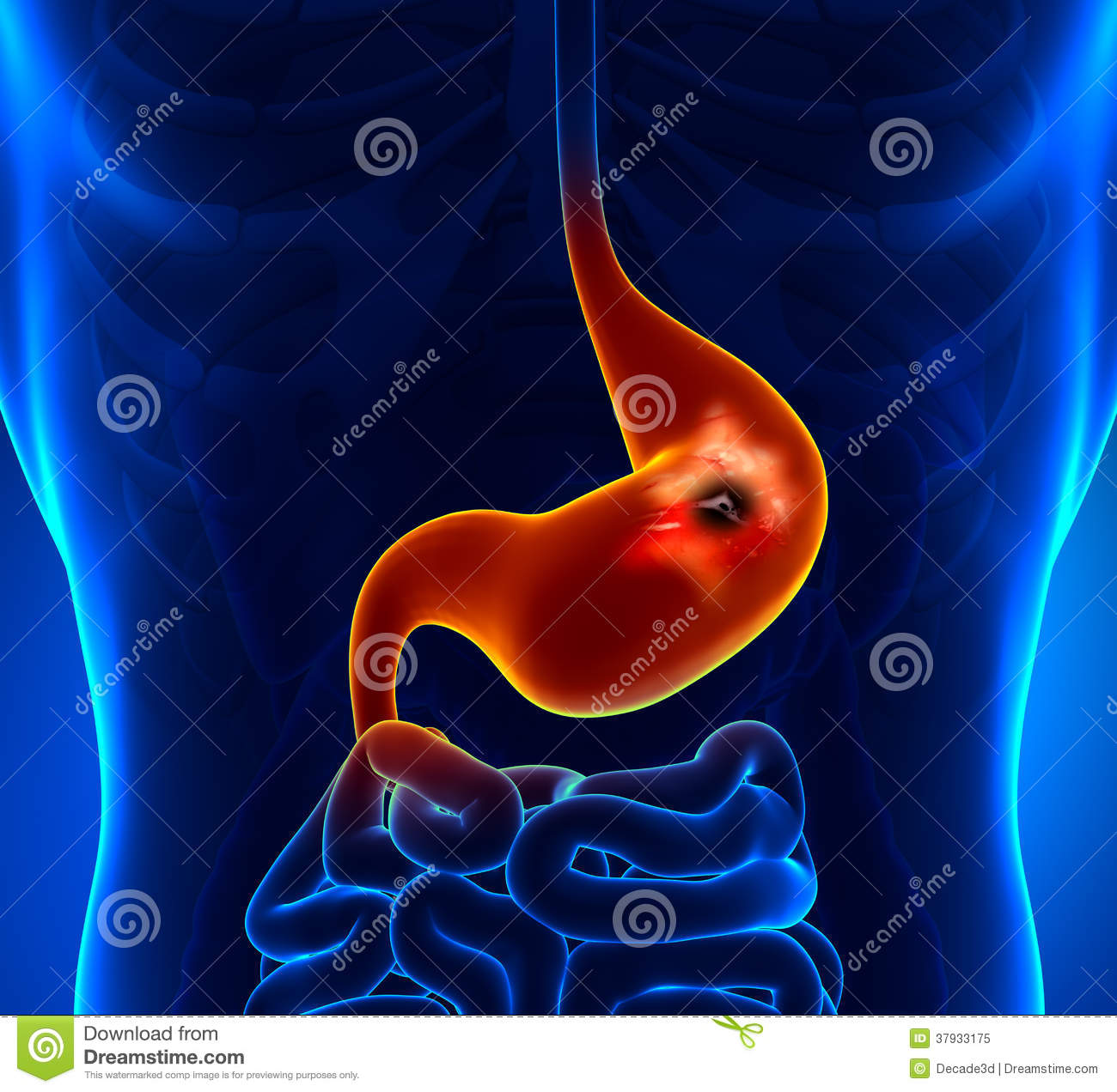 Enfermedad ácido péptica: