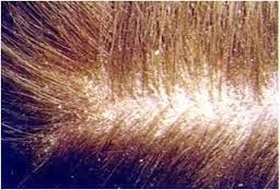 Visual Make: Solução de tratamento para caspa, seborréia e dermatite ...