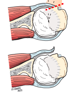 Shoulder Arthritis/Joint Replacement Rotator cuff tears: Lesser ...
