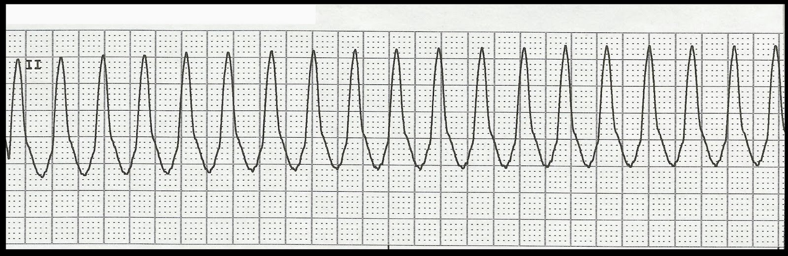 EKG Rhythm Strip Quiz 185