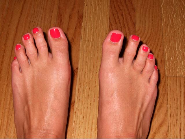 My Toe Shortening Surgery