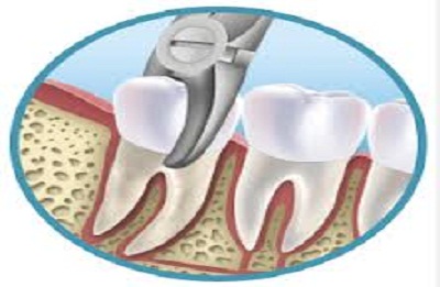 wisdom tooth extraction : Simple and Surgical Extractions