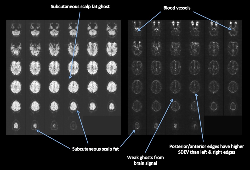 practiCal fMRI: the nuts & bolts: Understanding fMRI artifacts: "Good ...