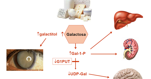 Arturo Bustillos Viera: Galactosemia: Cuadro clínico