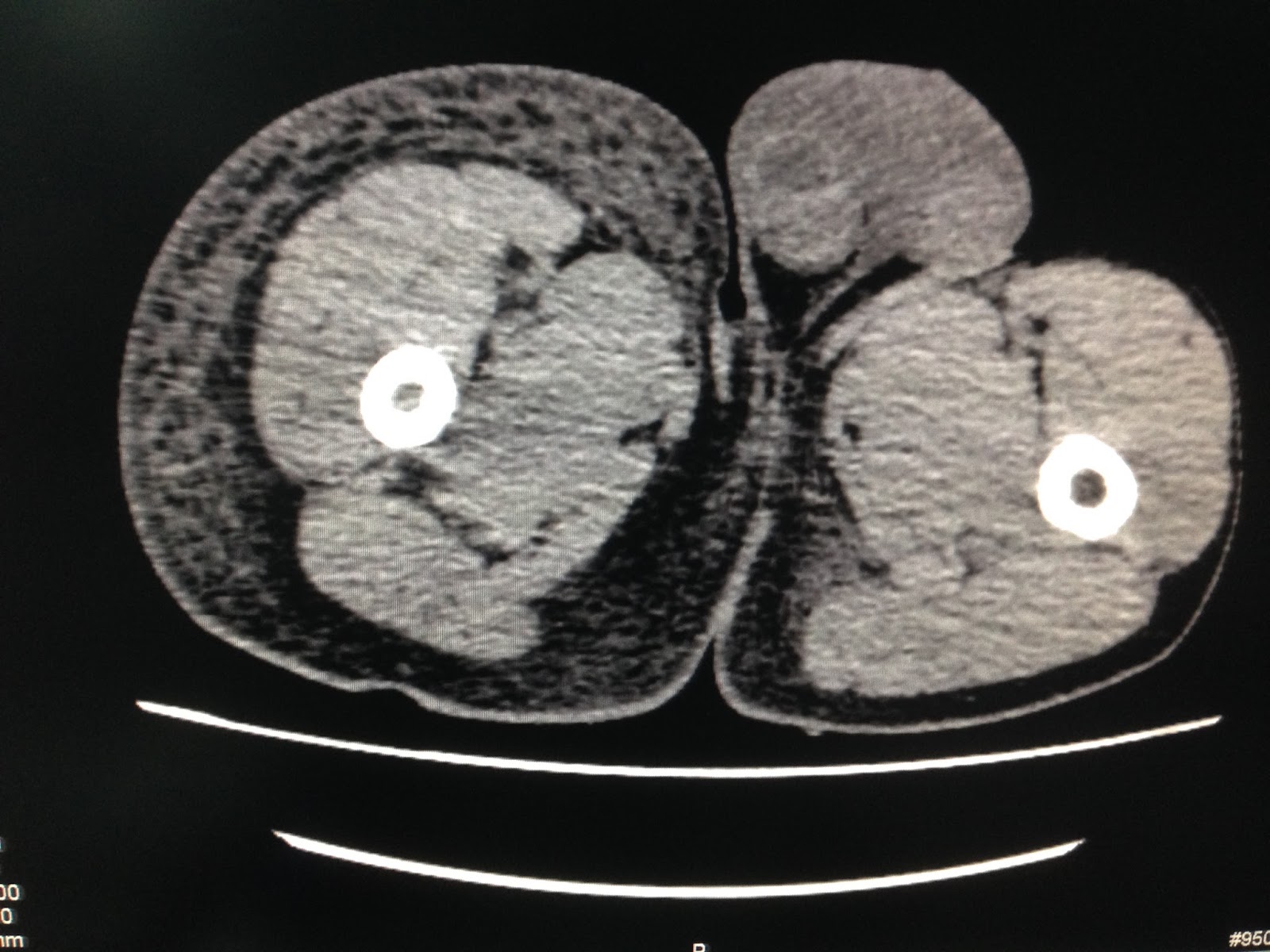 VIETNAMESE MEDIC ULTRASOUND: CASE 323: ELEPHANTIASIS, Dr PHAN THANH HẢI ...