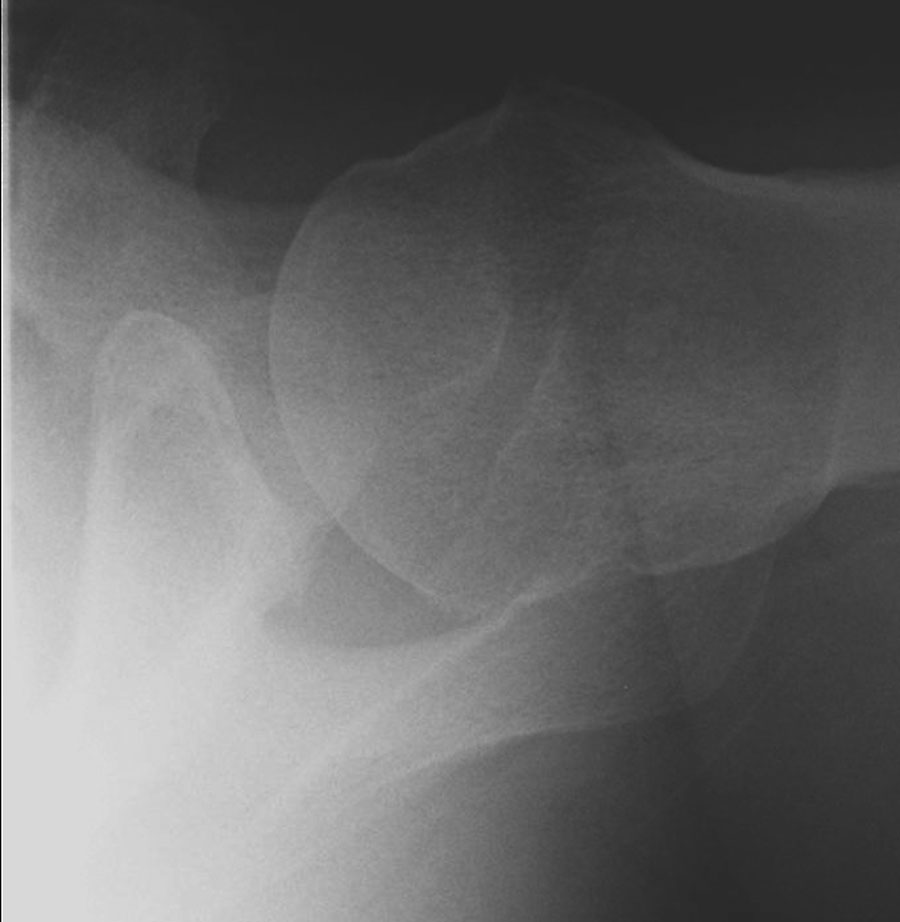UW Shoulder and Elbow Academy: Dysplasia of the shoulder, x-ray appearance
